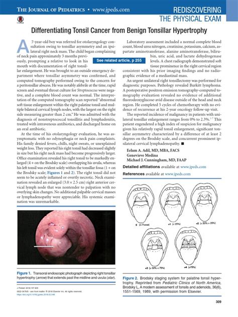 Differentiating Tonsil Cancer From Benign Tonsillar Hypertrophy Pdf Epidemiology Medical