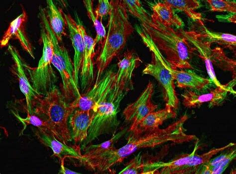 Stem Cell Transplants Improve On Current Ms Treatments