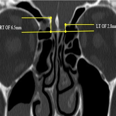 Keros Classification According To Gender Among Different Studies N Download Scientific Diagram