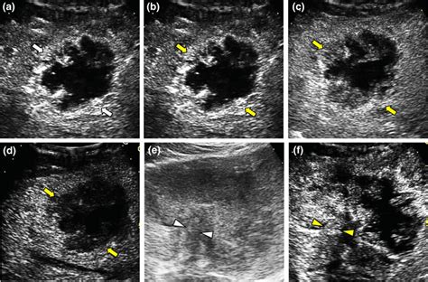 It Illustrates An Hcc Lesion Categorized Lr M Subclass Of Lr Tiv A Download Scientific Diagram