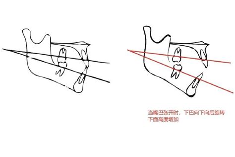 青岛牙齿矫正：矫正一年缓解嘴突闭唇紧张，下颌逆旋出俏下巴 知乎