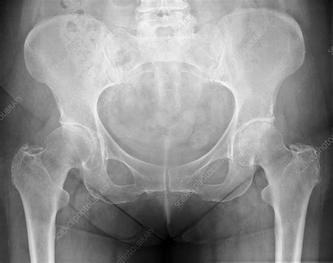 Hip X Ray With Osteoarthritis At Jordan Mealmaker Blog