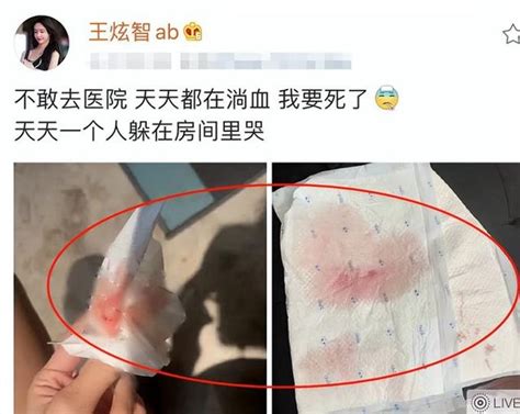 Abbily“變性”半年未痊癒，晒照被指太血腥，網友：非練葵花寶典