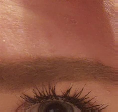 Small Forehead Pop I Have Very Clogged Pores On My Face And Get These