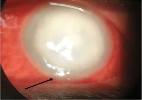 Pseudomonas Keratitis From Diagnosis To Successful Deep Anterior