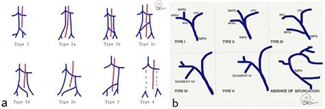 A Classification Of Ivc Abnormalities B Variations Of The