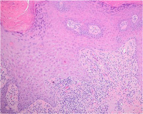 Representative High Magnification Hematoxylineosin Stain Of A Skin