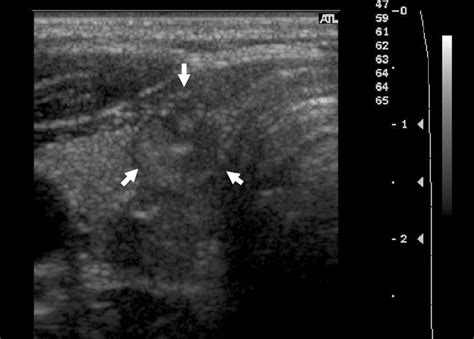 Thyroid Usg Shows 1 Cm Hyperechogenic Nodule In Right Lobe White