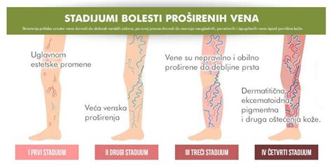 Prirodno Lečenje Proširenih Vena Prirodni Lekovi za Proširene Vene