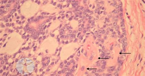 Adenoid Cystic Carcinoma Pathology Image