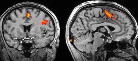 Functional Mri In Cognitive Neurosurgery
