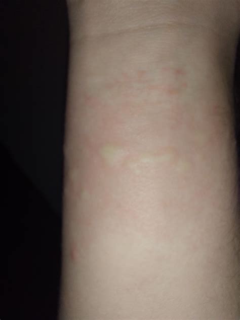 Aftermath Of Playing With Rats Does This Mean Im Allergic Red Rash