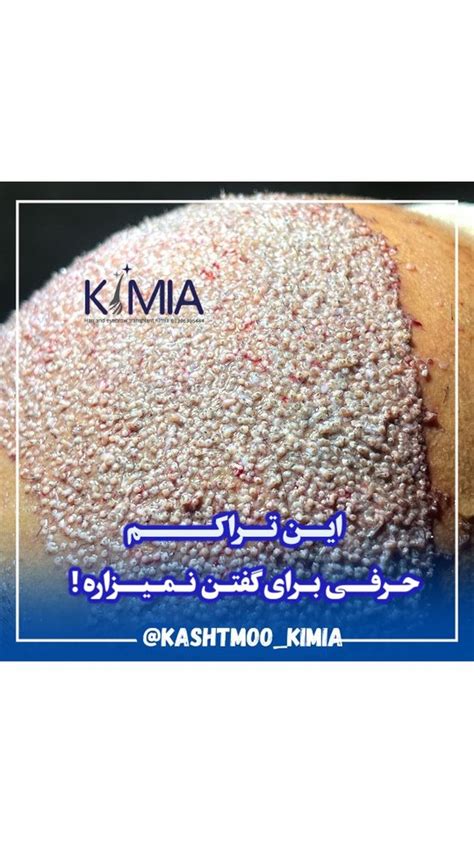‎کاشت مو کیمیا کاشت مو شیراز کاشت ابرو مزوتراپی‎ ‎به این نتیجه