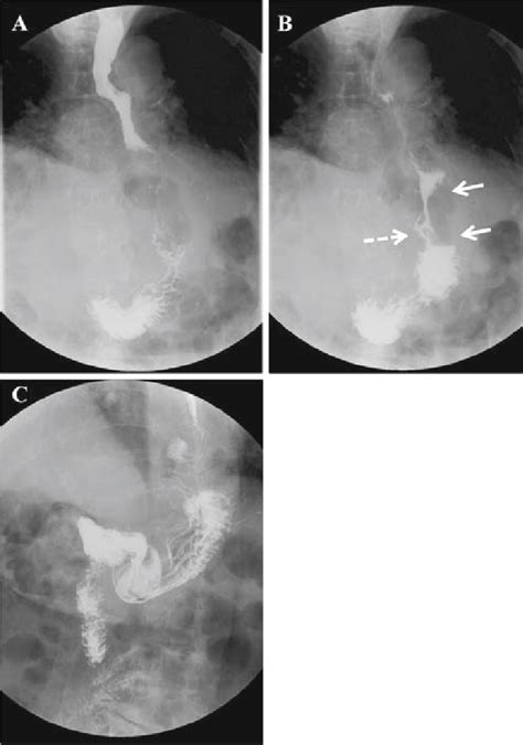Postoperative Upper GI Series 36 Months After Surgery A There Is Download Scientific Diagram