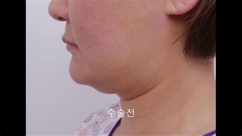 중년 이중턱 지방흡입 포도송이 이중턱 없애기 53일차 경과 Youtube
