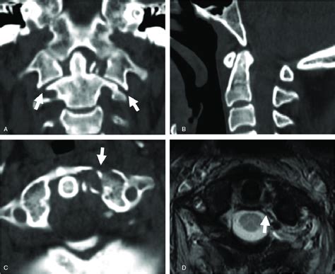Unilateral Sagittal Split Fracture With Transverse Atlantal Ligament Download Scientific