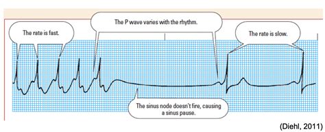 Sick Sinus Syndrome Risks Commonqery