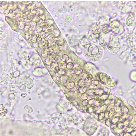 Cilindro Eritroide En Sedimento Urinario Laboratorio Clínico