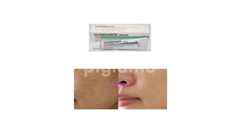 Clonovate Skin Lightening Cream 15g Very Effective In Nairobi Cbd
