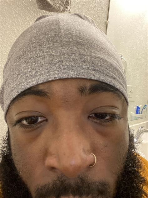 I Burned My Eyelids Top And Bottom 2 Years Ago With A Chemical Peel Pad