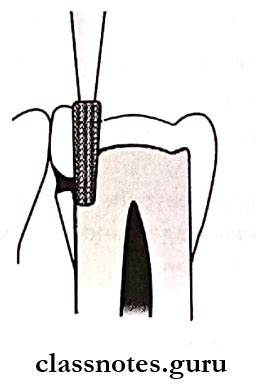 Cavity Preparation For Cast Metal Restorations Question And Answers