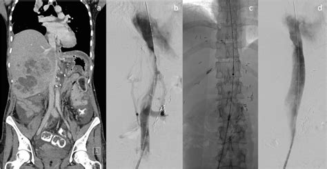 25 Year Old Female Patient With Hepatic Metastasis Of A Retroperitoneal