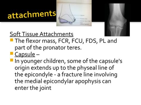 Apophyseal Injuries Of Elbow Medial Epicondyle Avulsion Fractures Ppt