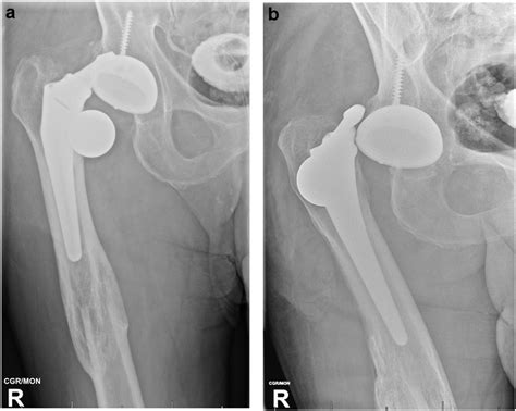 Preoperative Anteroposterior Radiograph A And Attempted Lateral