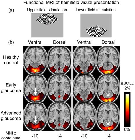 Functional Mri Of Visual Cortex Activity In Glaucoma And Healthy