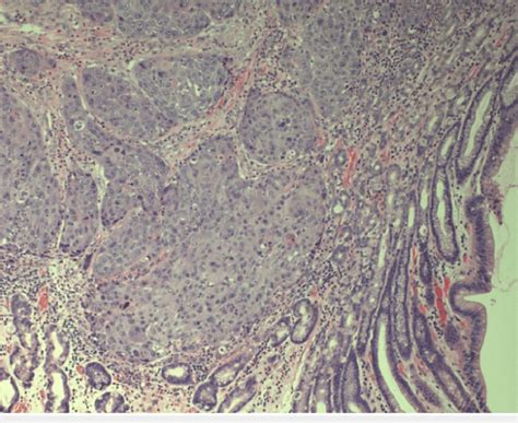 Squamous Cell Carcinoma Of Similar Morphology To Hypopharyngeal