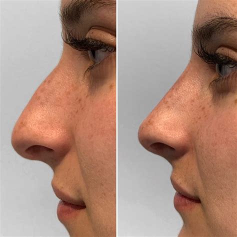 Nose Dermal Filler In Melbourne Artofit