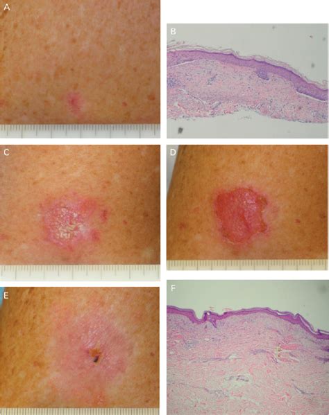 5 5‐fluorouracil Cream For The Treatment Of Small Superficial Basal