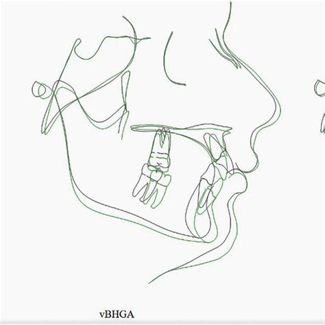 Pdf Cephalometric Effects Of Twin Block And Van Beek Headgear Activator In The Correction Of