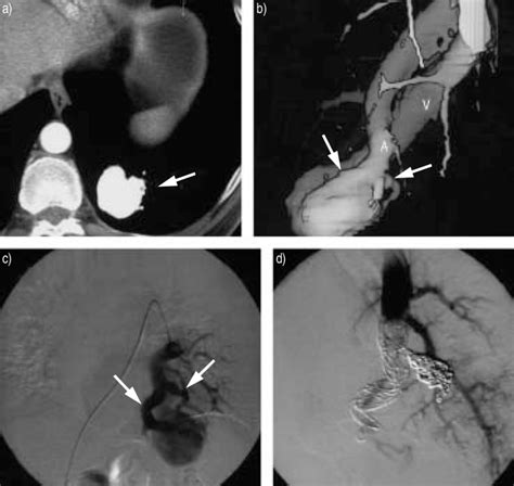 Embolisation Of Pulmonary Artery Vascular Malformation Pavm A