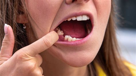 Perdi Um Dente E Não Quero Fazer Implante Conheça As Opções E