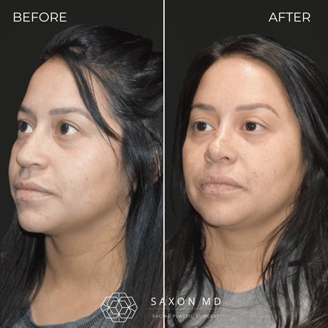Nose Job Recovery Time What To Expect After Rhinoplasty