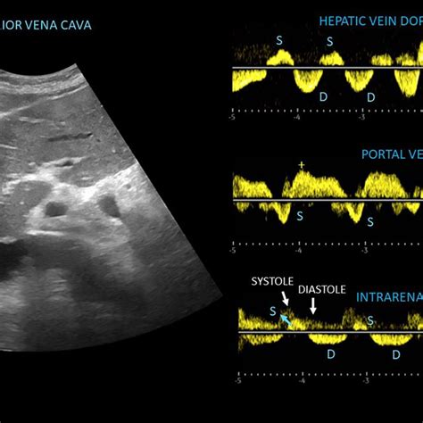 Inferior Vena Cava Ultrasound And Venous Doppler Patterns From The