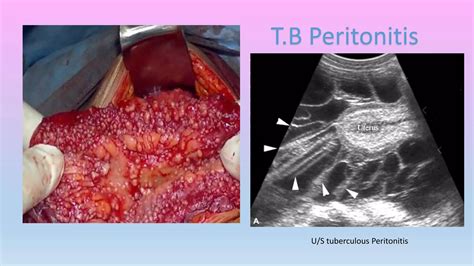 Differential Diagnosis Of Cloudy Effluent In Peritoneal Dialysis Pdf