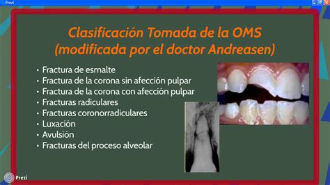 Traumatismo Dental