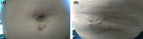 Development Of Keloidal Morphea After Treatment With Cyclosporine In A