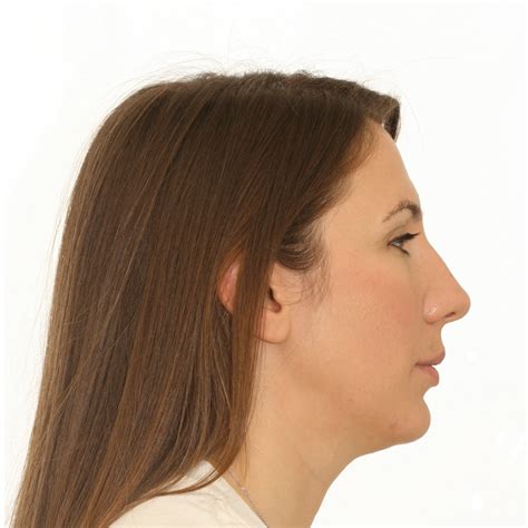 Lower Incisor Extraction Case — E Line Orthodontics