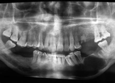 Cysts Of The Jaw Pseudocyst