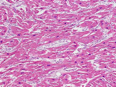 Pin By Richard Jones On Forensic Pathology Natural Disease Pinter…