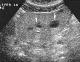 Liver Cyst