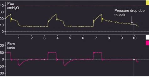 Ahmed Dahab On Linkedin End Inspiratory Occlusion With Leakage The Plateau Pressure Will Be…