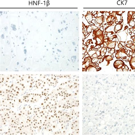The Representative Morphological And Immunohistochemical Findings Of
