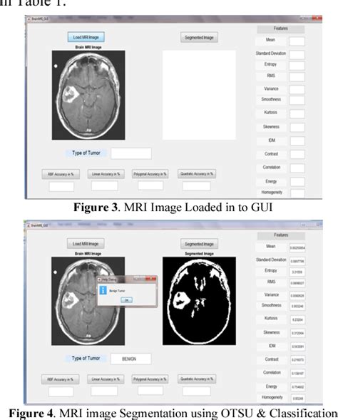 Figure 4 From Powerful And Novel Tumour Detection In Brain Mri Images