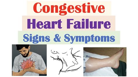 Congestive Heart Failure Signs Symptoms Why They Occur Youtube