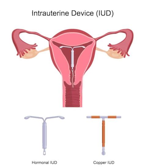 First Period After Iud Insertion 5 Worst Signs Of Iud Infection