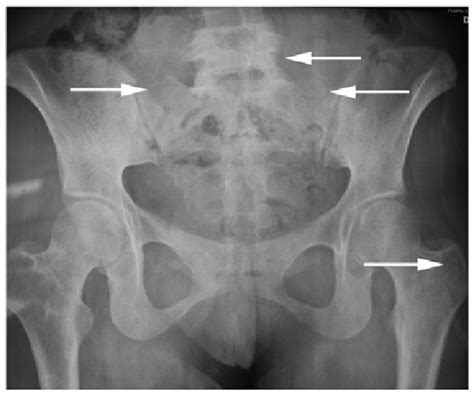 Si Joint Dysfunction X Ray At Karan Katz Blog